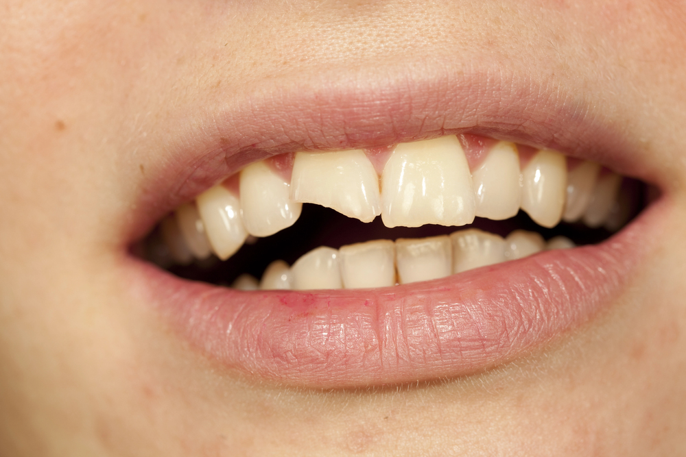 Why Ignoring a Broken Tooth Can Lead to Serious Problems - Metro Dental ...
